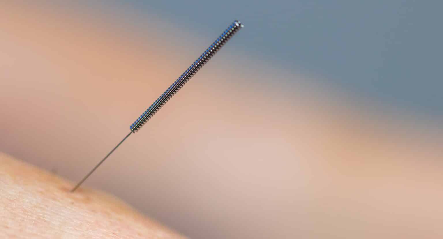 Trigger Point Therapy vs Dry Needling vs Injections | Charlotte, NC